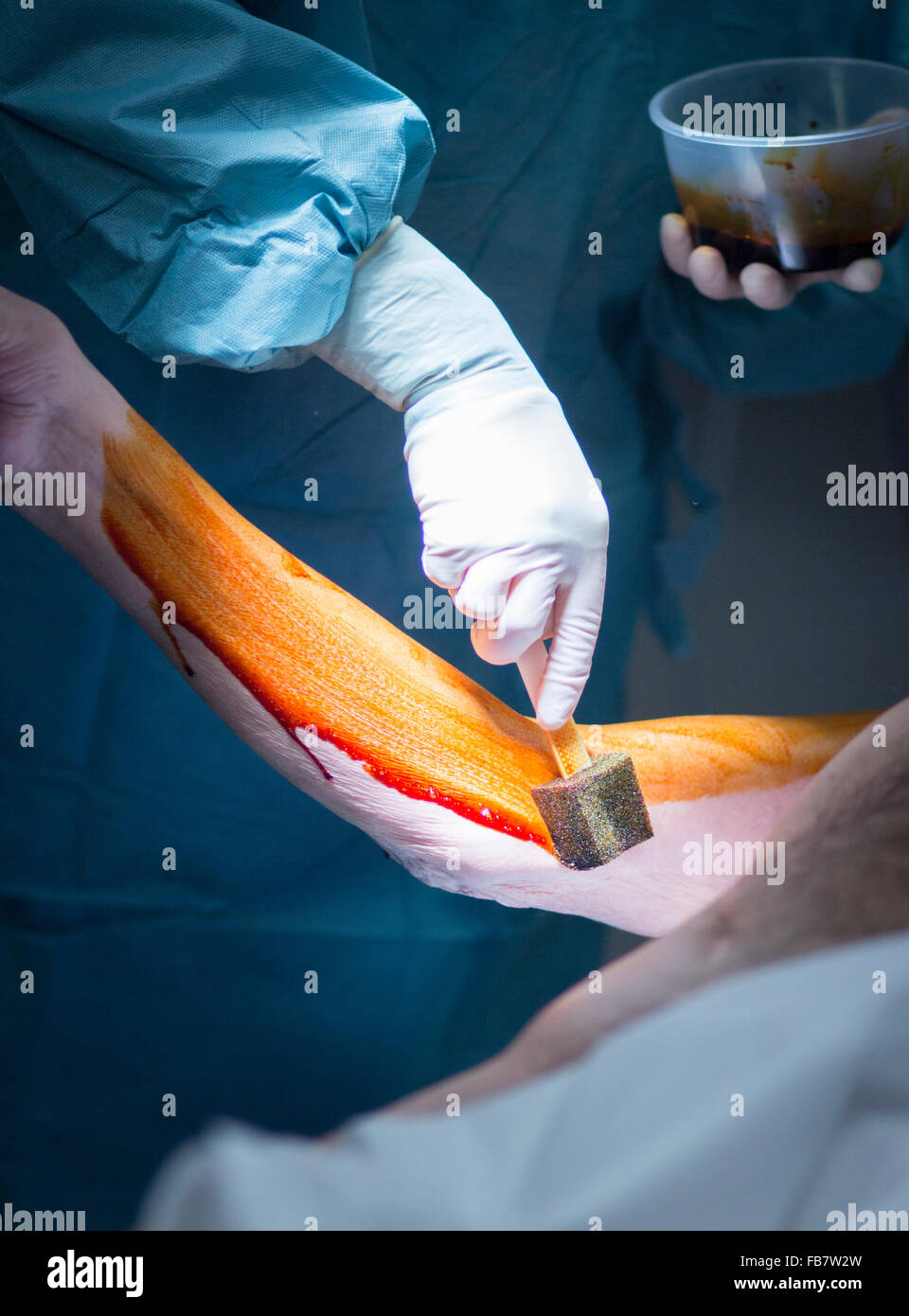 Hospital elbow surgery emergency orthopedics arm operation operating ...