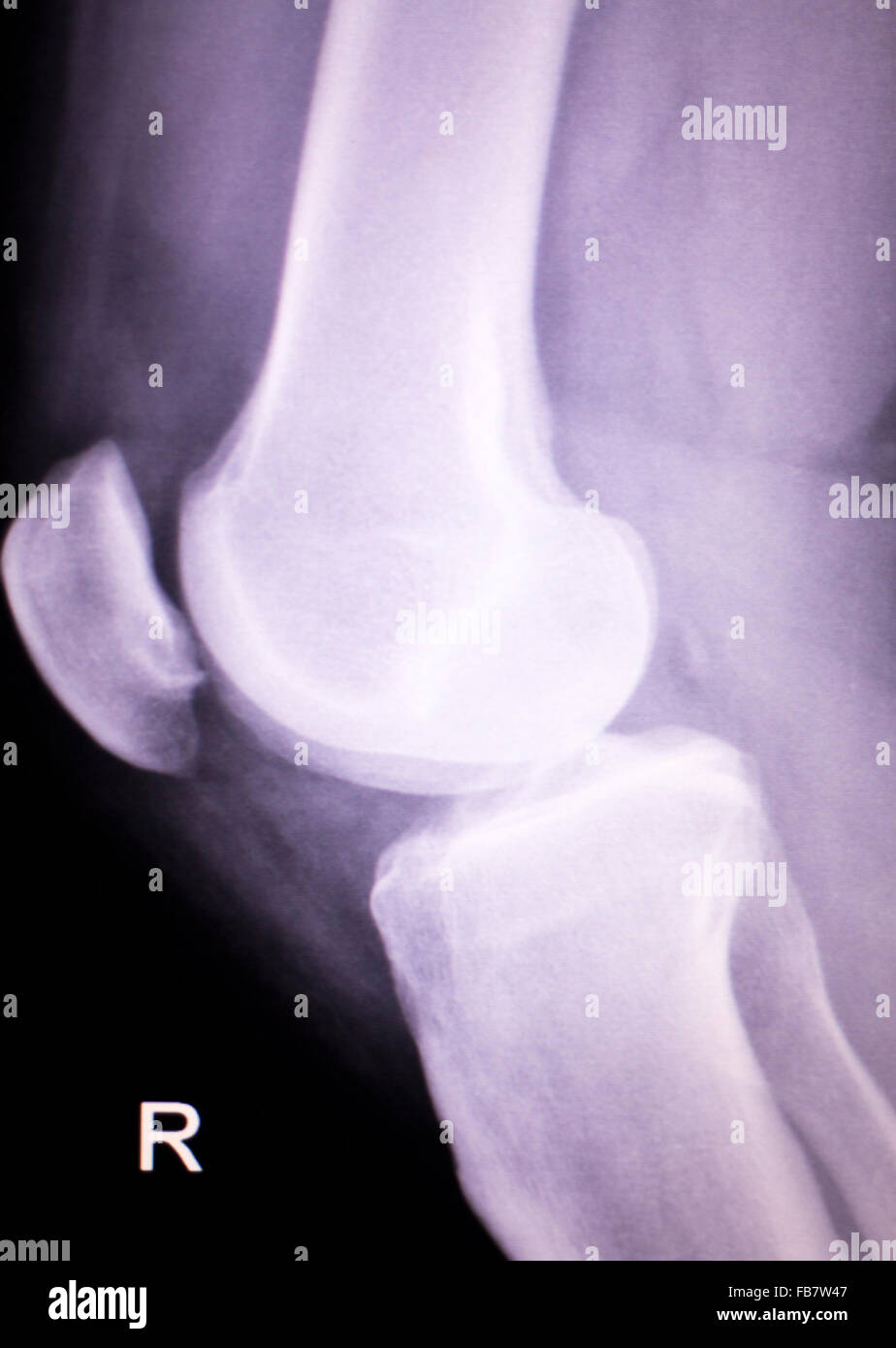 Knee joint meniscus x-ray test scan results photo showing injury and ...