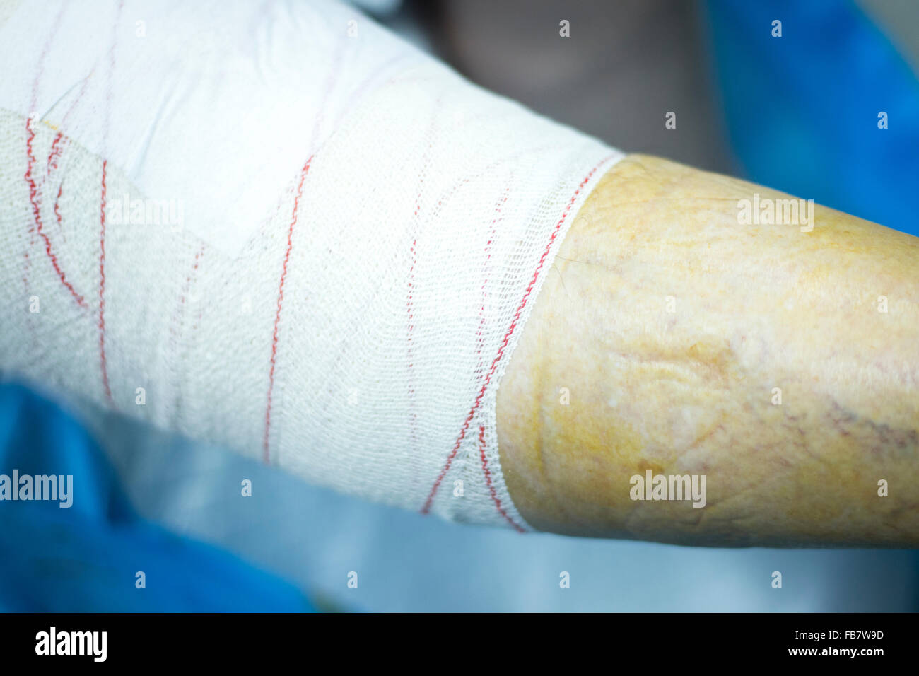 Knee arthroscopy orthopedic surgery operation in hospital emergency ...