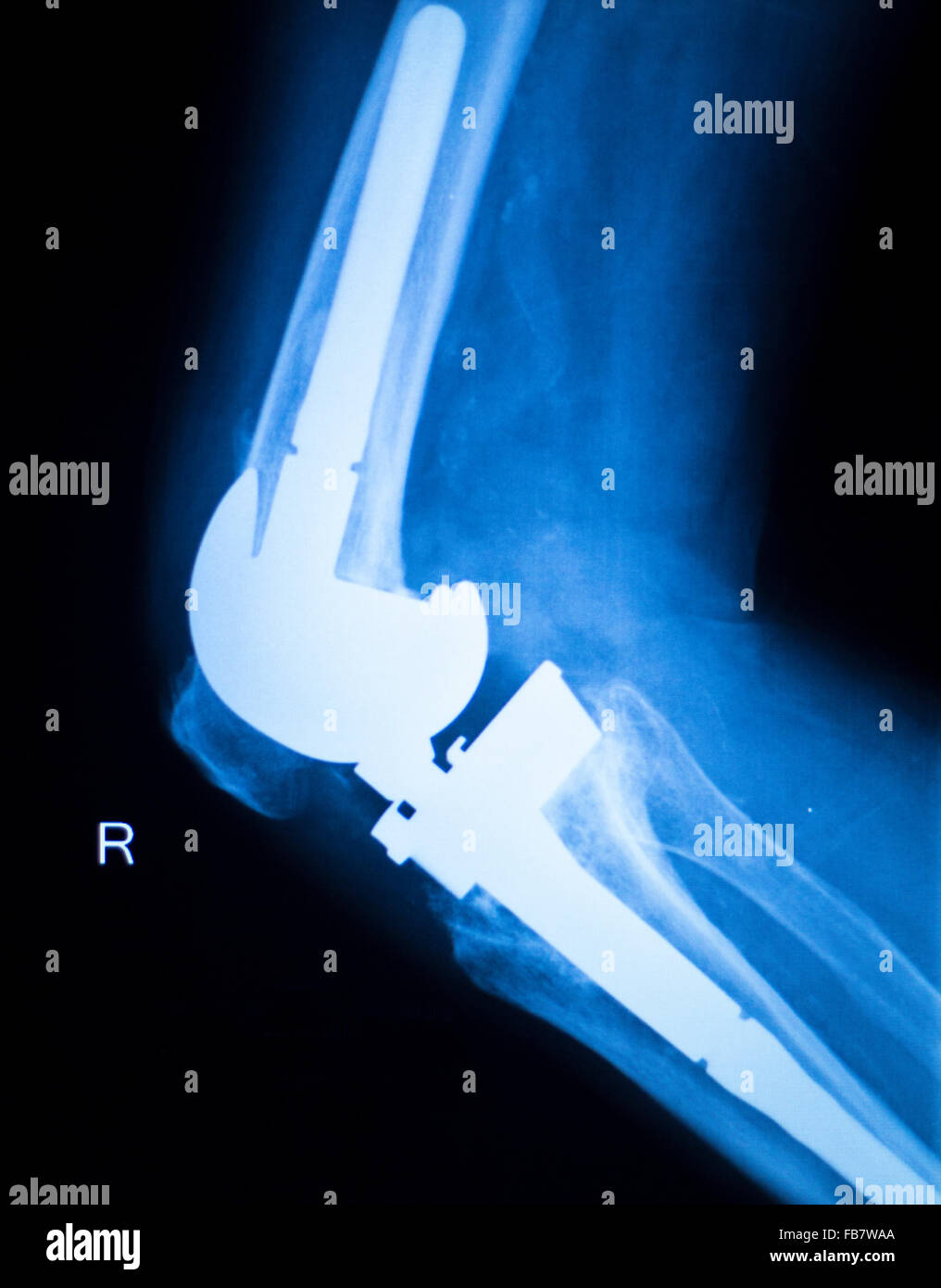 Knee joint meniscus x-ray test scan results photo showing injury and ...