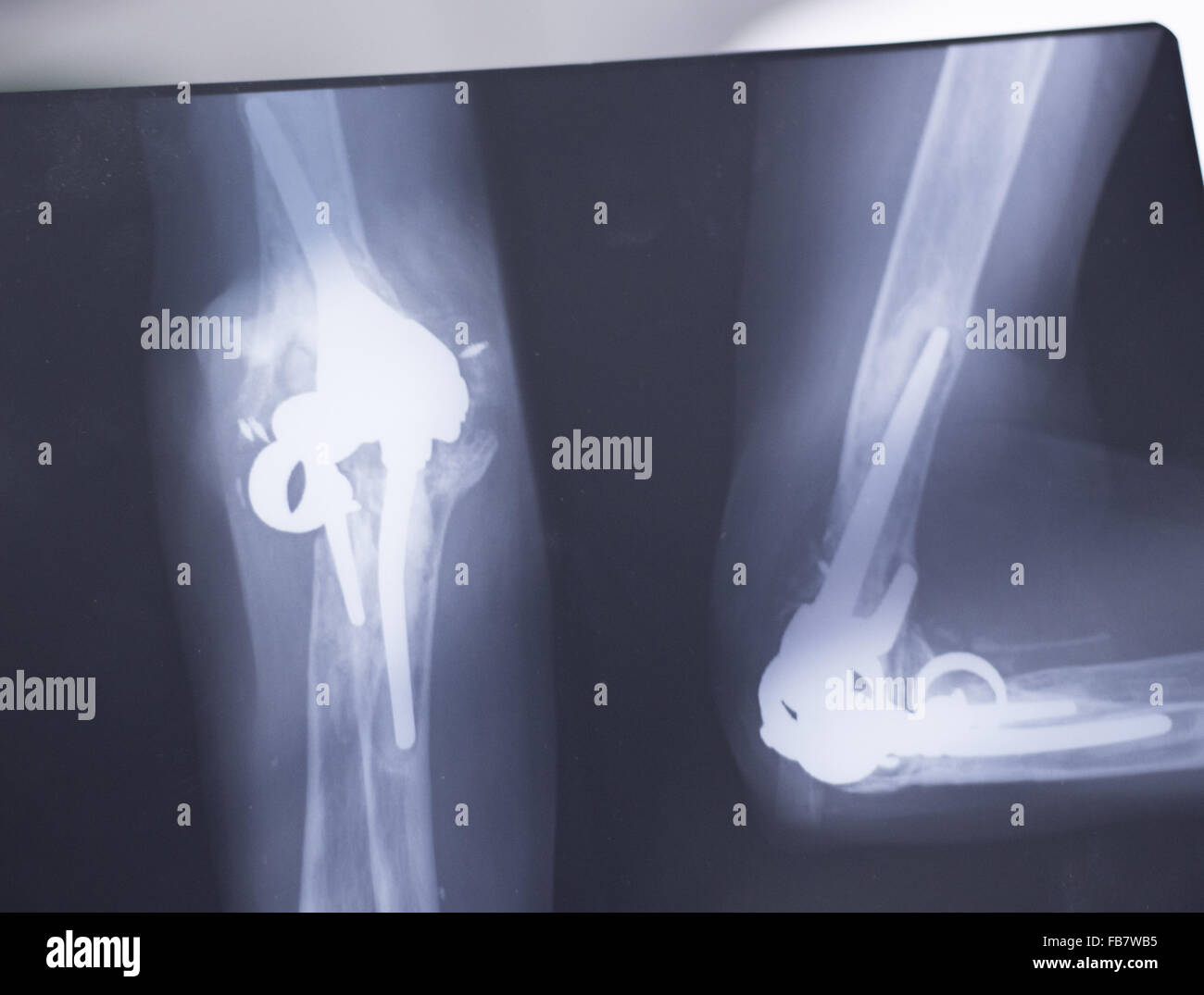 Othopedics and Traumatology surgical implant arm and elbow xray test ...