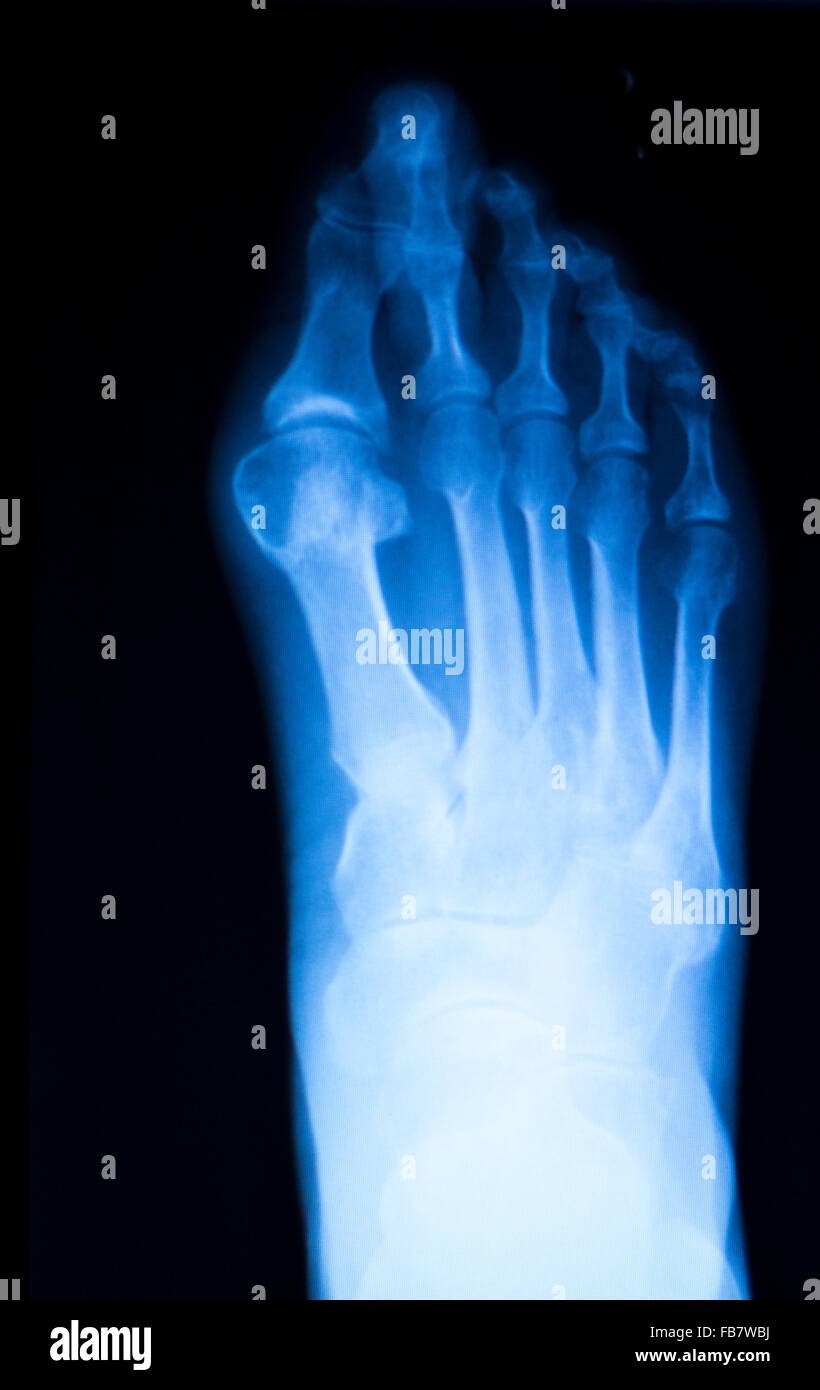 Foot and toes injury x-ray scan orthopedics and Traumatology radiology ...