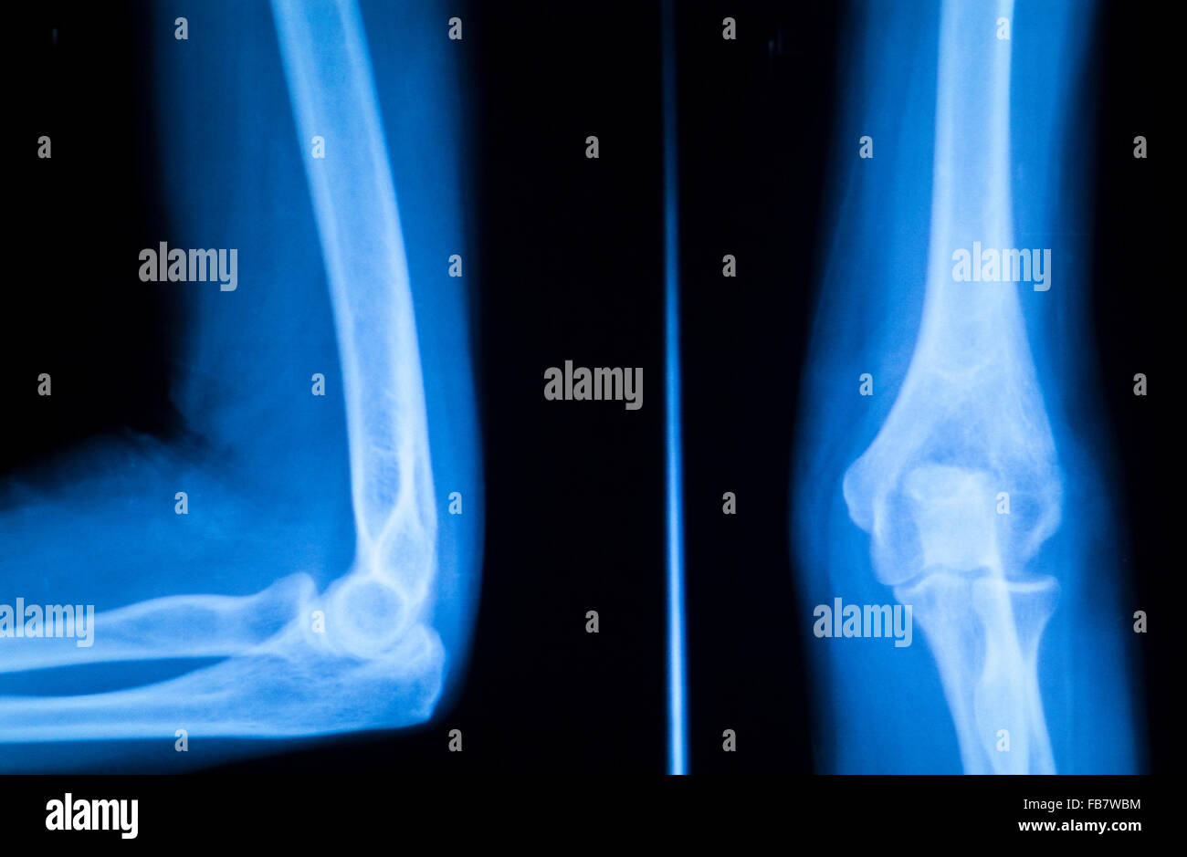 Othopedics and Traumatology surgical implant arm and elbow xray test ...