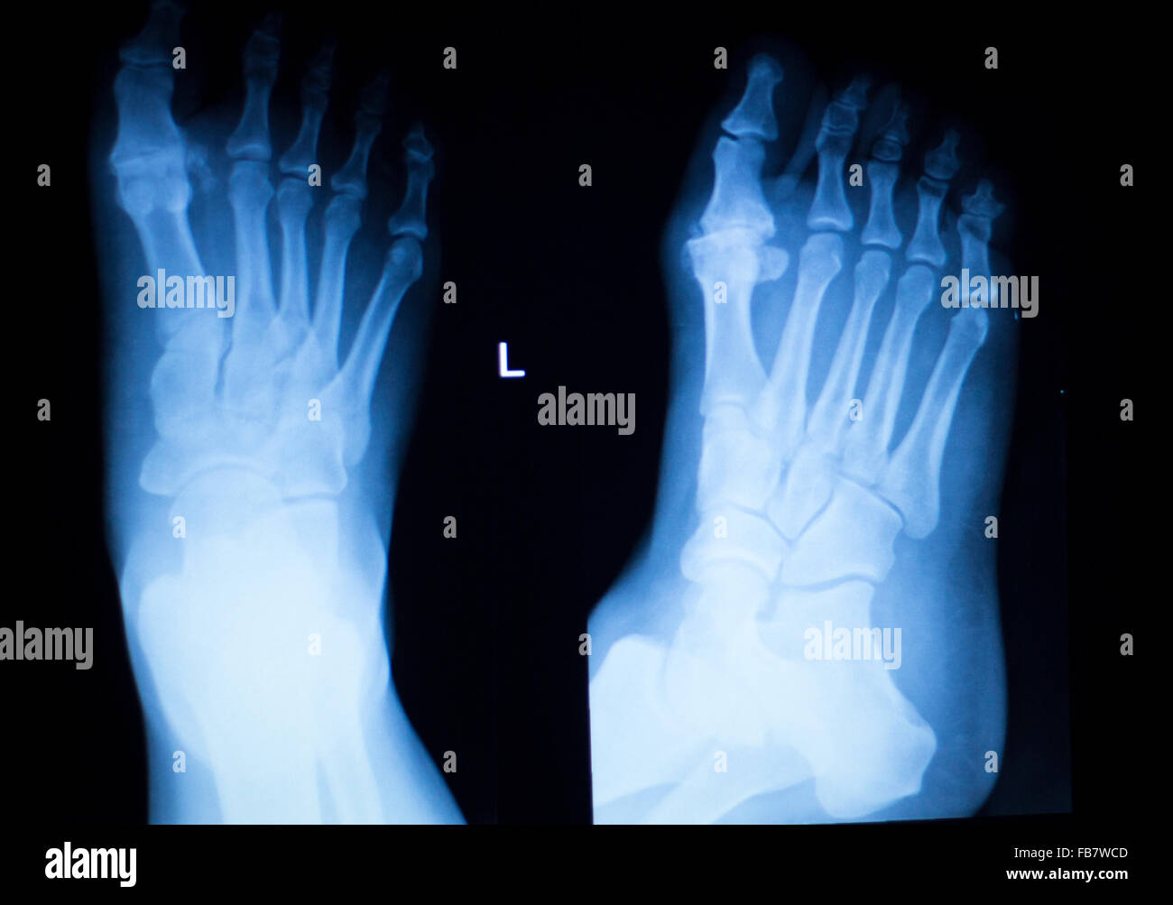 Foot and toes injury x-ray scan orthopedics and Traumatology radiology ...