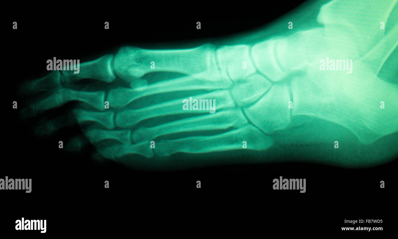 Foot and toes injury x-ray scan orthopedics and Traumatology radiology ...