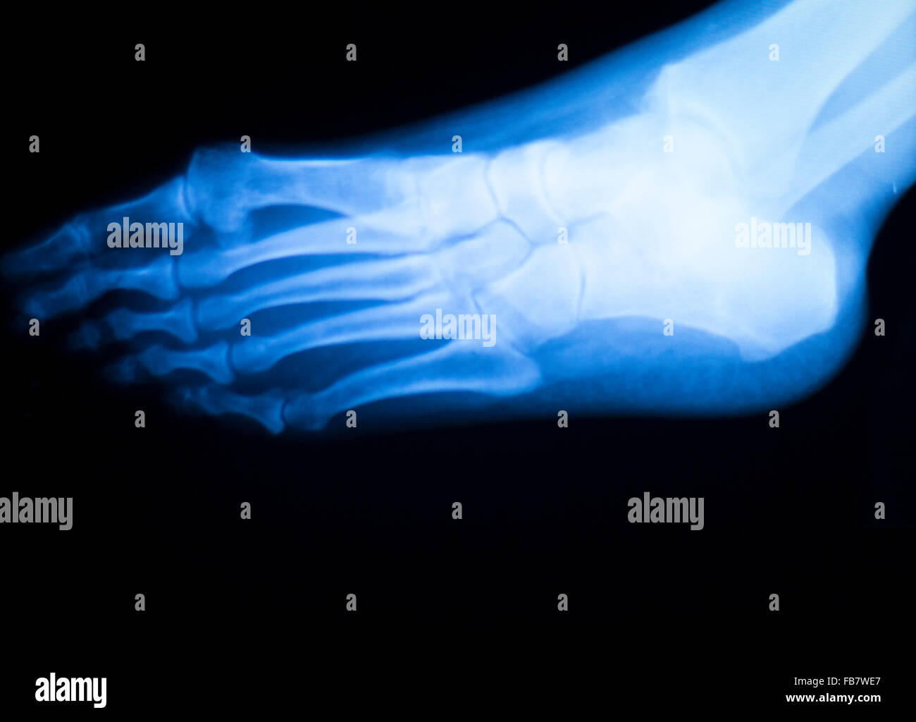 Foot and toes injury x-ray scan orthopedics and Traumatology radiology ...