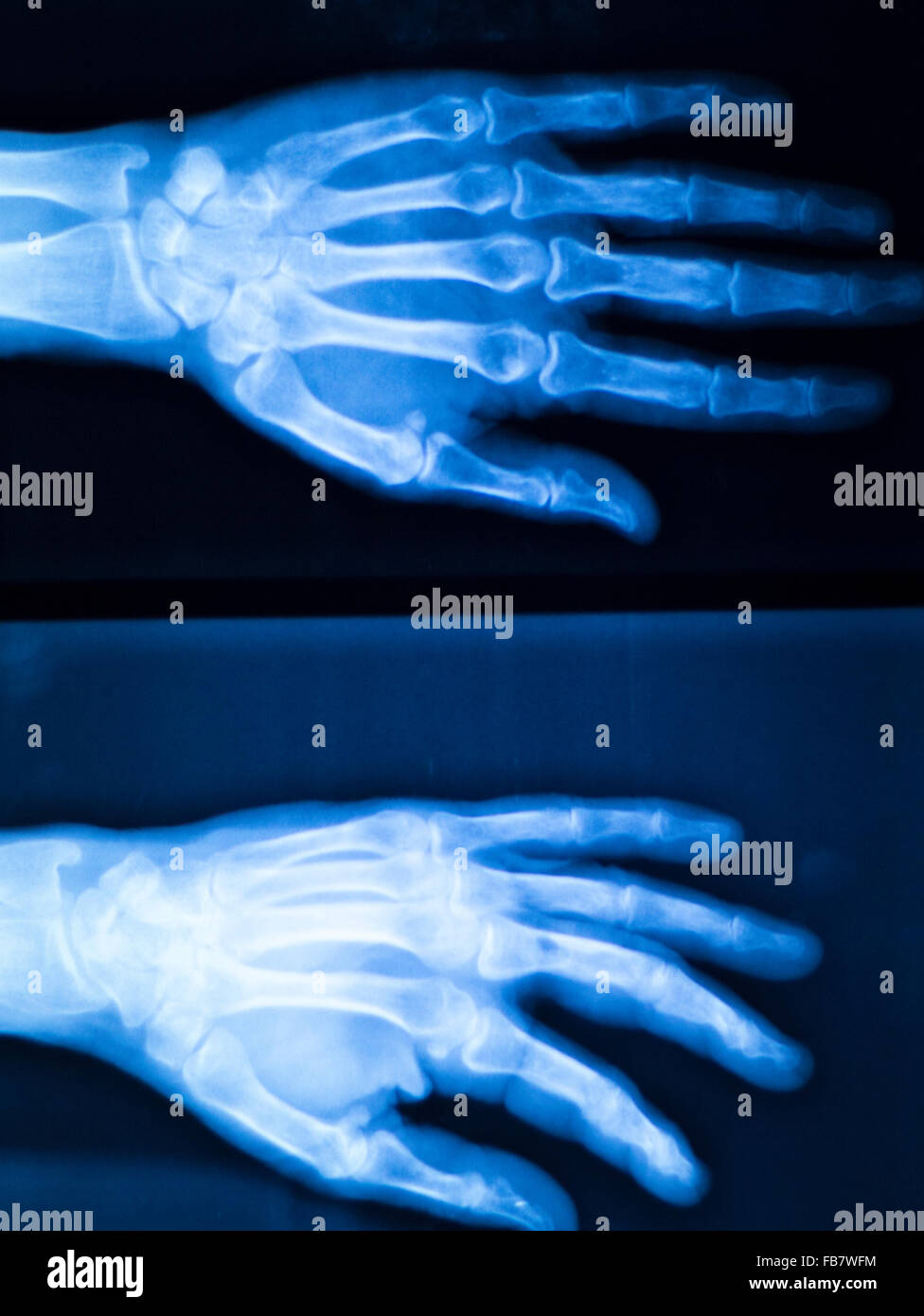 Hand, fingers and thumb hospital x-ray scan test results for joint pain ...