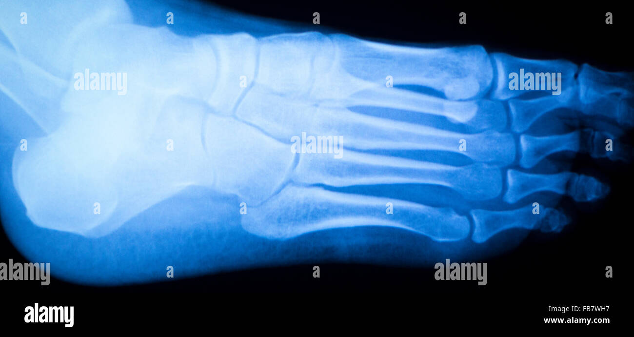 Foot and toes injury x-ray scan orthopedics and Traumatology radiology ...