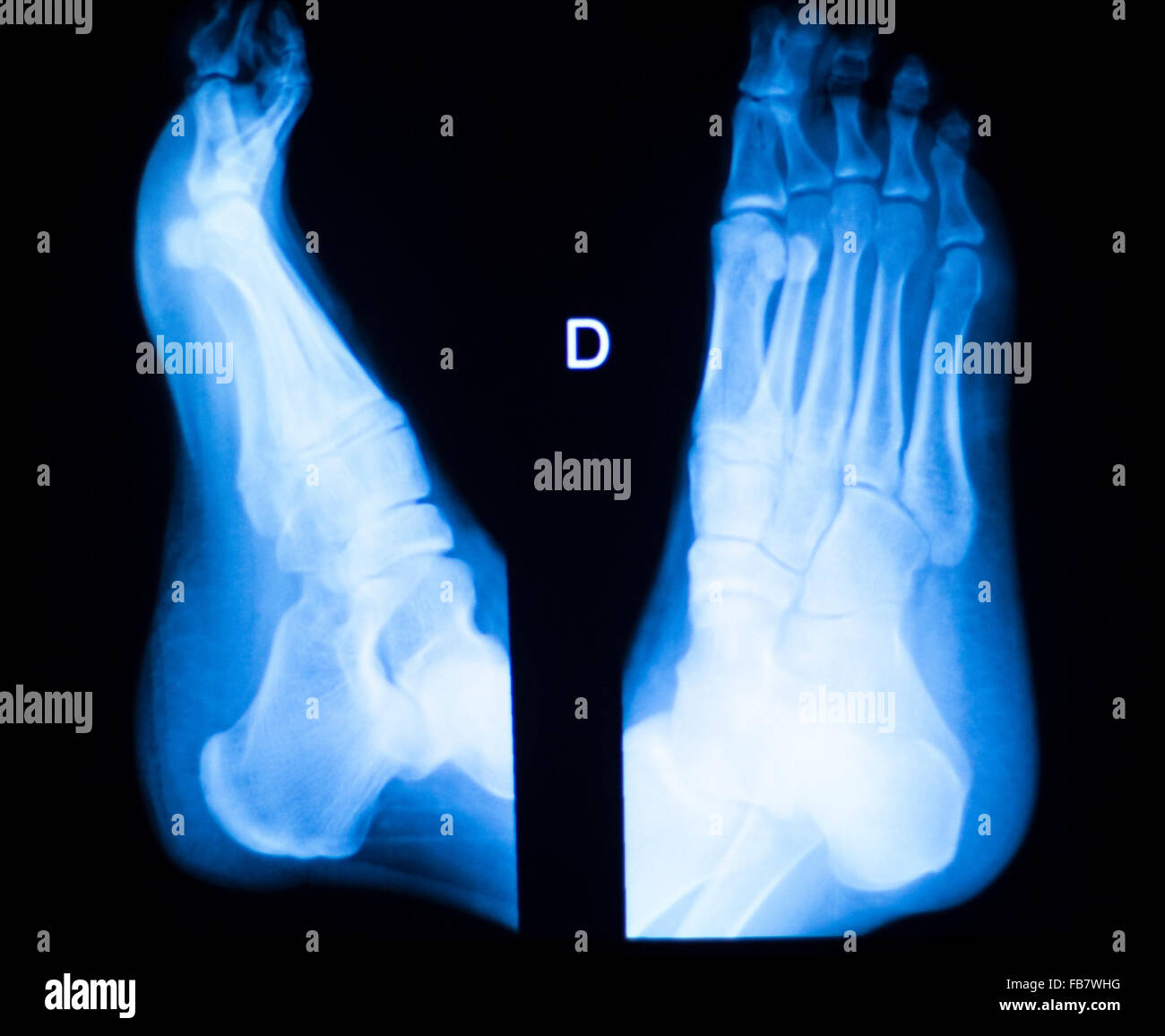 Foot and toes injury x-ray scan orthopedics and Traumatology radiology ...
