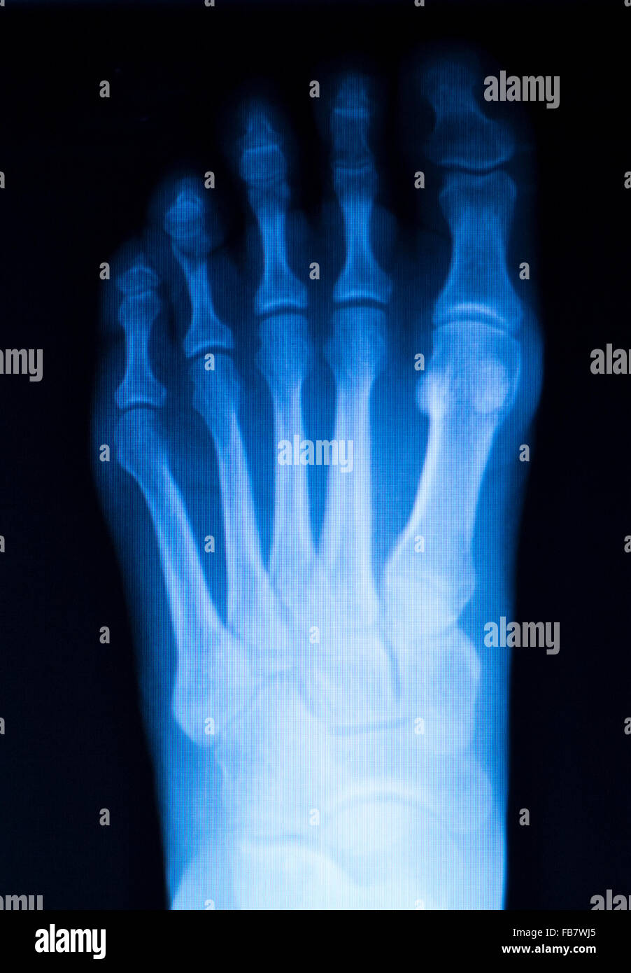 Foot and toes injury x-ray scan orthopedics and Traumatology radiology ...