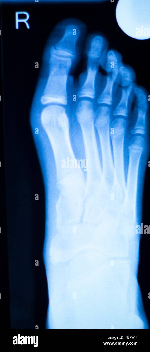 Foot and toes injury x-ray scan orthopedics and Traumatology radiology ...