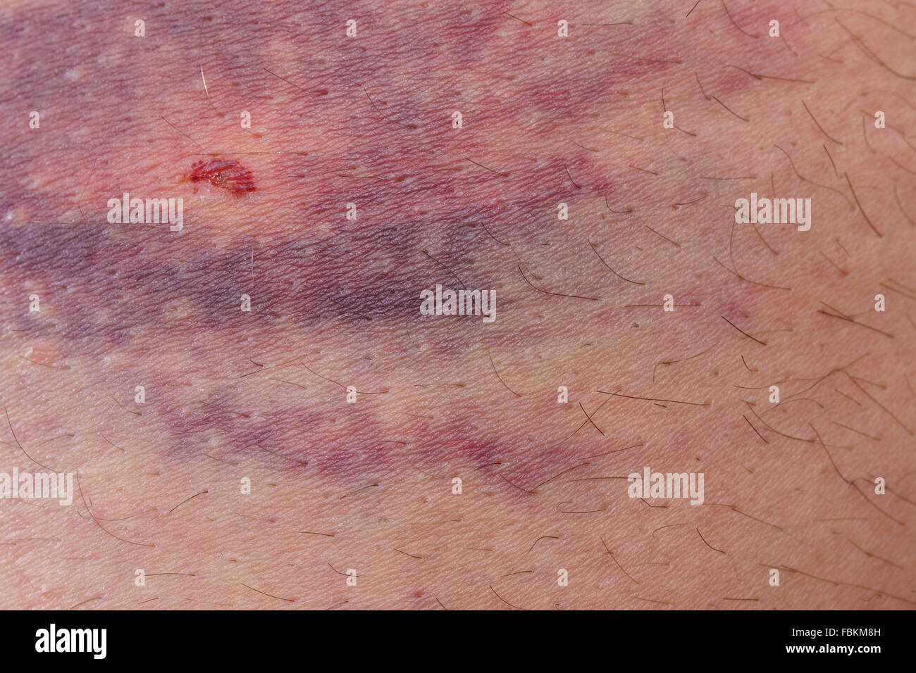 Closeup of bruise Stock Photo - Alamy