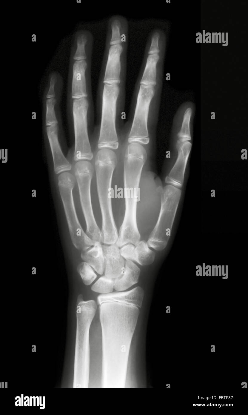 Left hand injury hi-res stock photography and images - Alamy