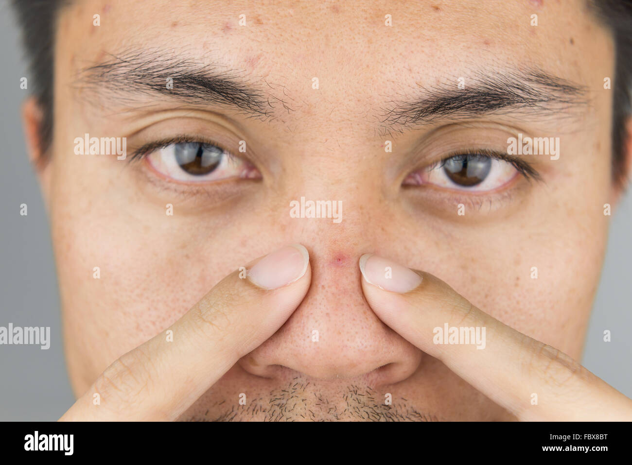 Pimple on skin close hi-res stock photography and images - Alamy