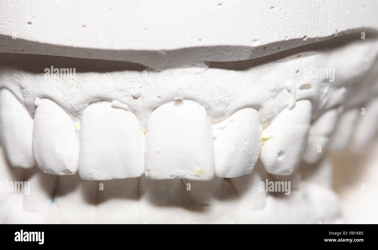 Dental Gypsum Waste Disposal at Susan Mcdaniel blog