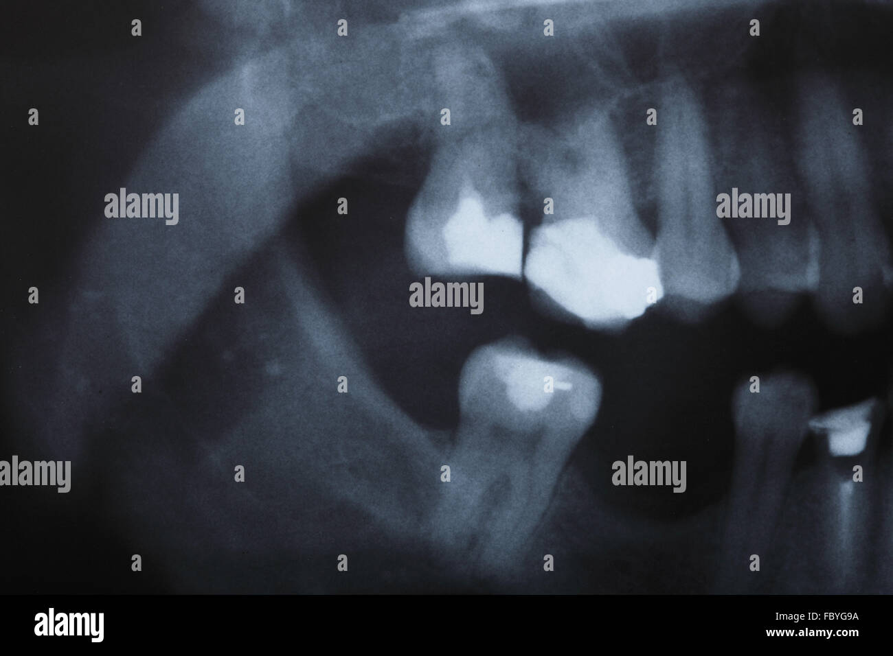 X ray of humans hi-res stock photography and images - Alamy