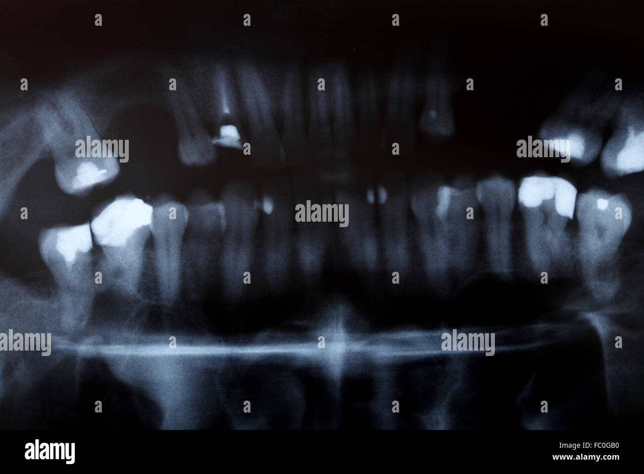 X-ray scan of humans teeth Stock Photo - Alamy