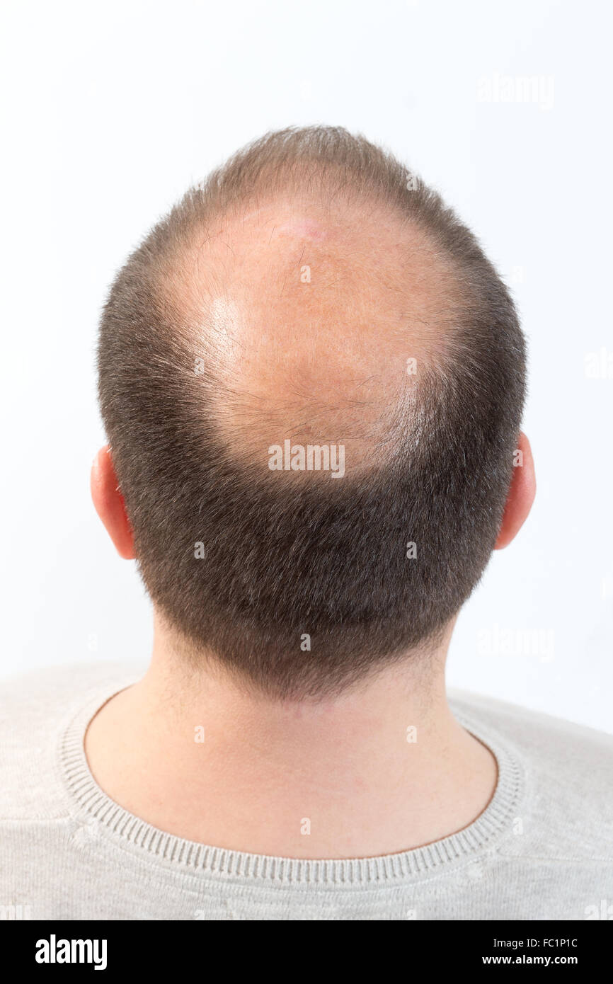 Alopecia male hi-res stock photography and images - Alamy