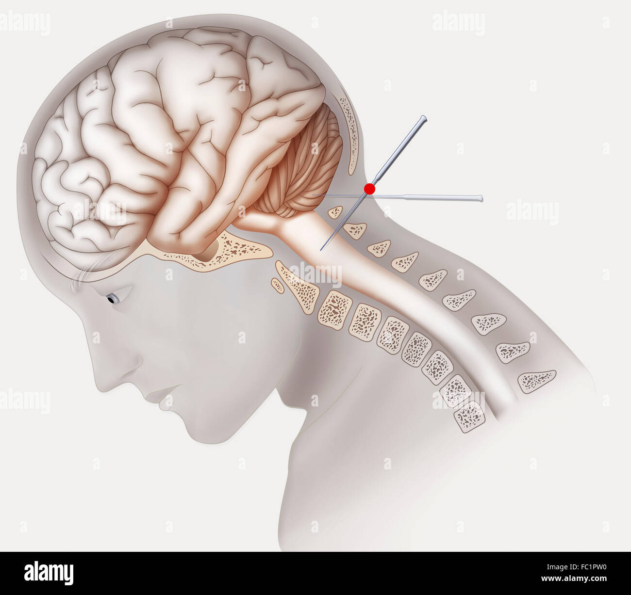 ACUPUNCTURE, DRAWING Stock Photo - Alamy