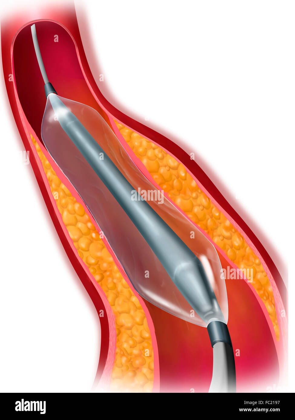 ARTERIAL ANGIOPLASTY, DRAWING Stock Photo - Alamy