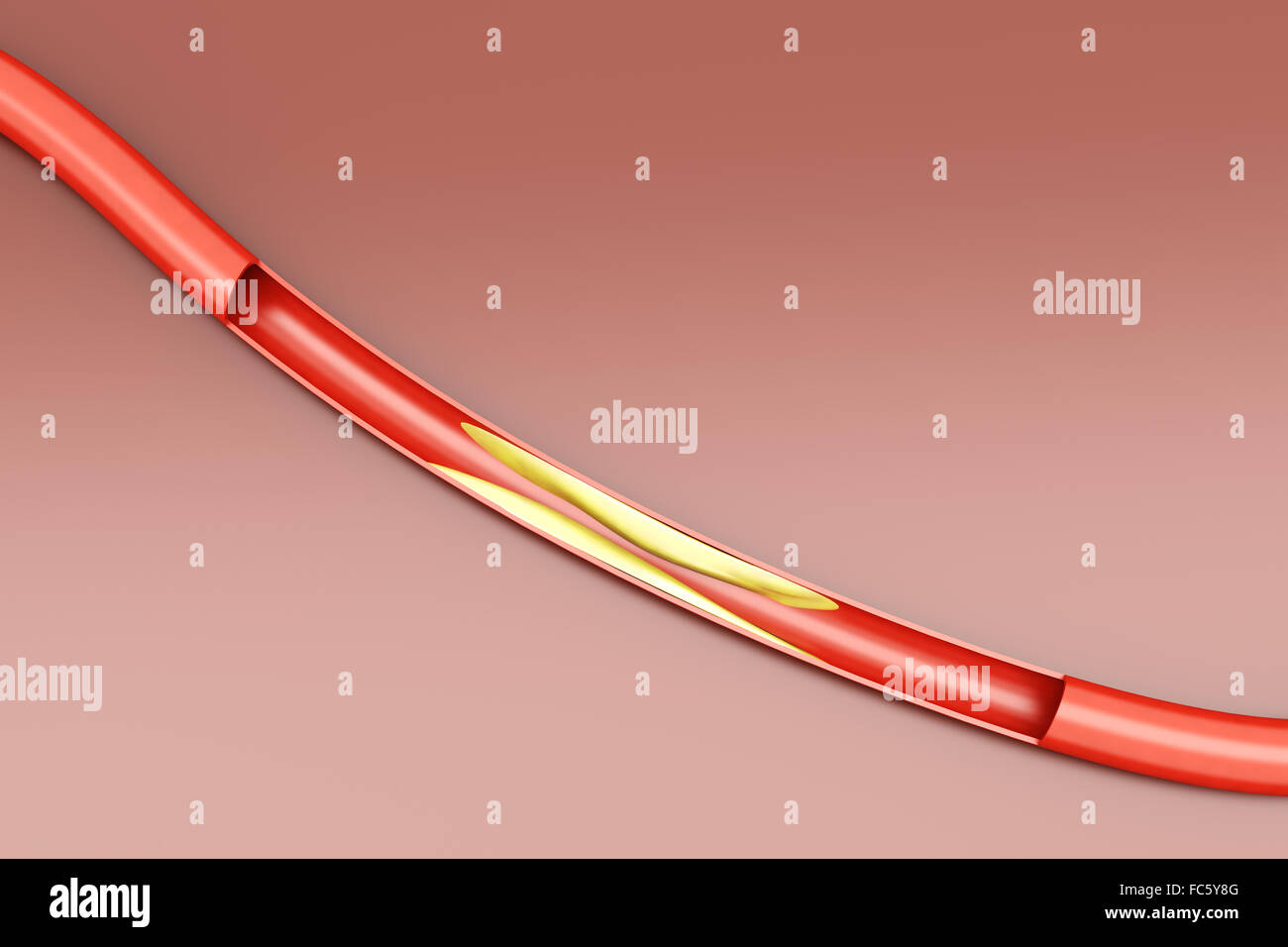 Arteriosclerosis therapy hi-res stock photography and images - Alamy