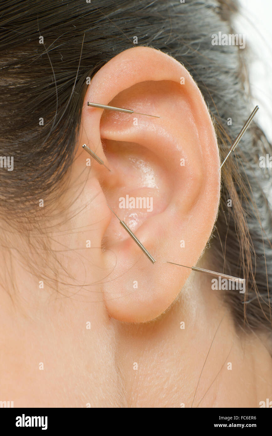 Girl acupuncture hi-res stock photography and images - Alamy