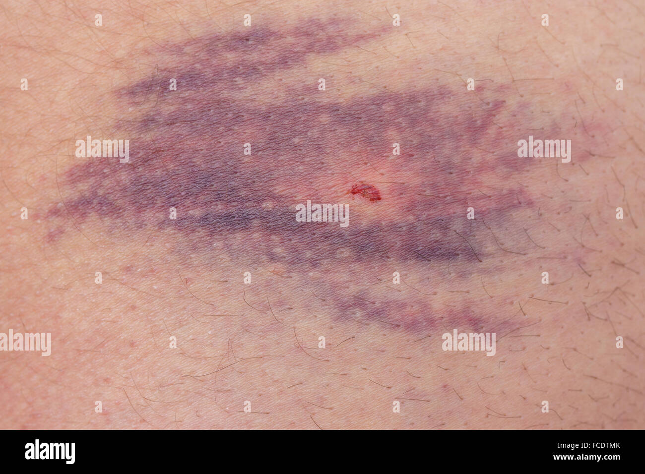 Closeup of big bruise over white skin Stock Photo - Alamy