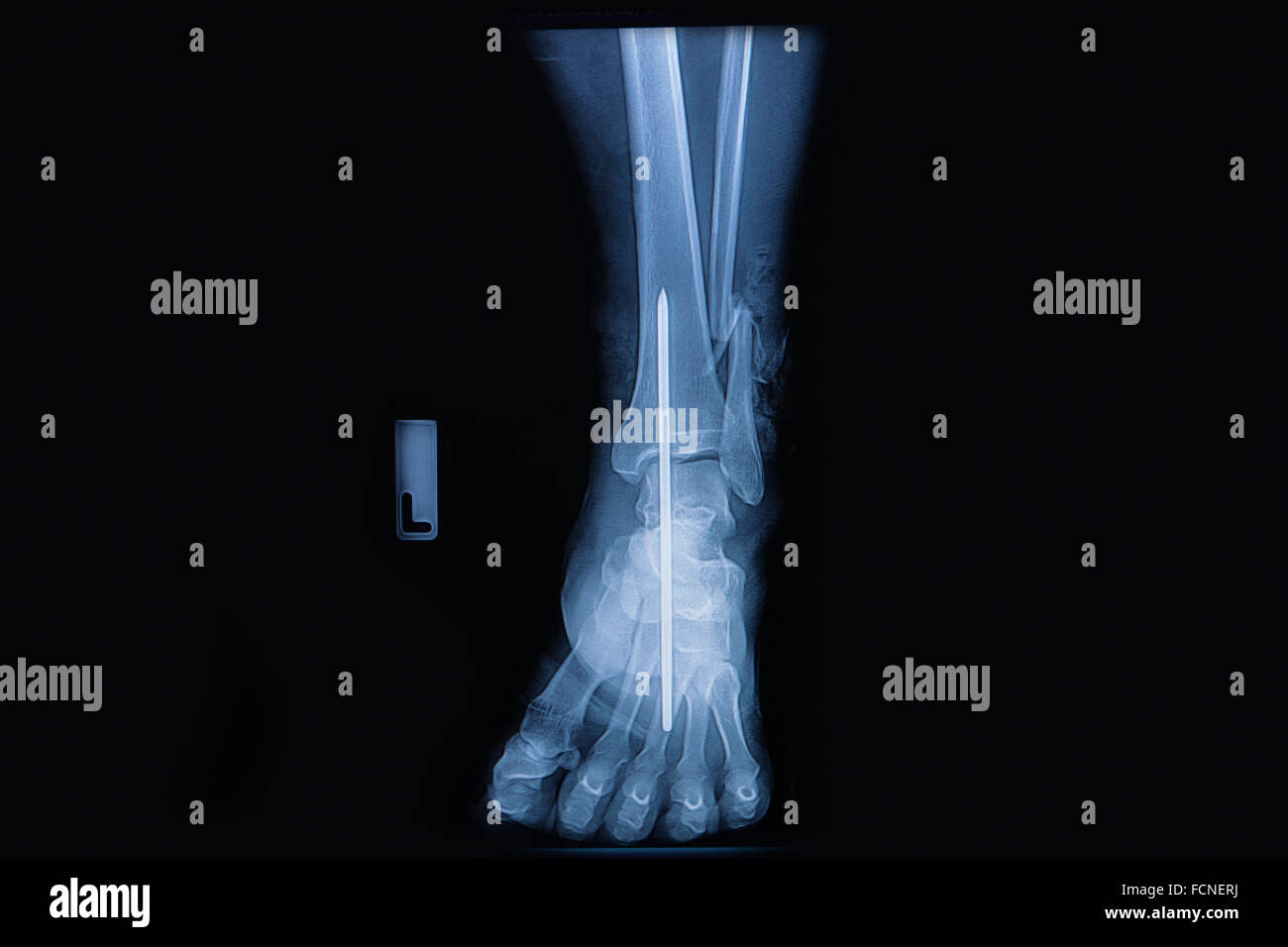 Lower leg fracture pin hi-res stock photography and images - Alamy