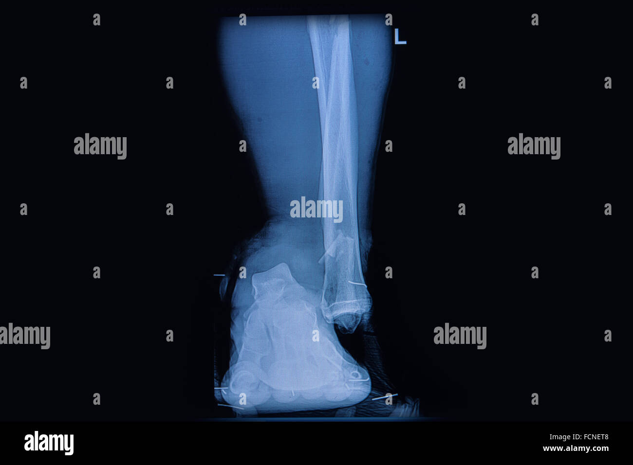 Fracture of the lower part of the fibula, front view X-ray Stock Photo ...