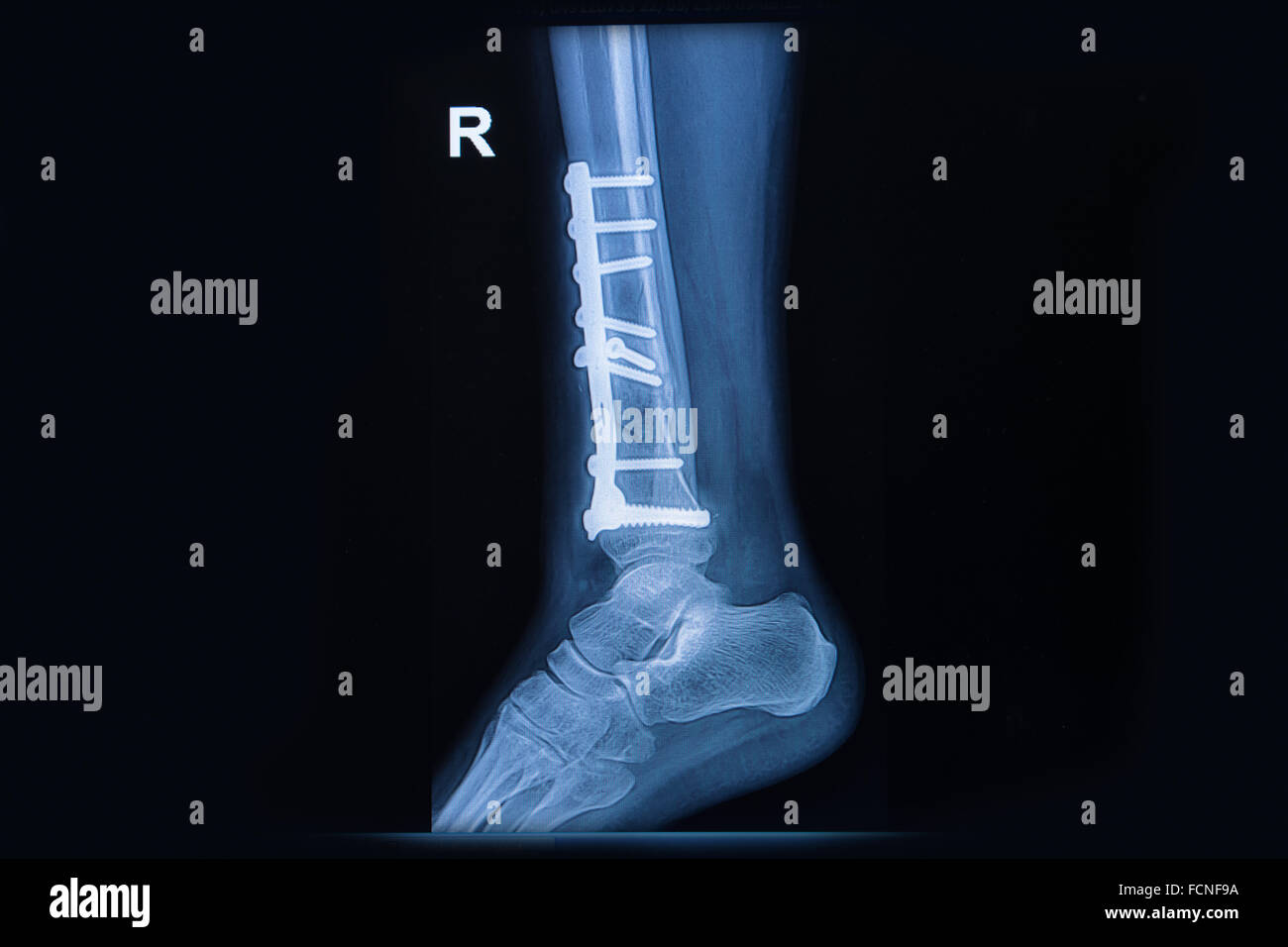 Distal tibia hi-res stock photography and images - Alamy