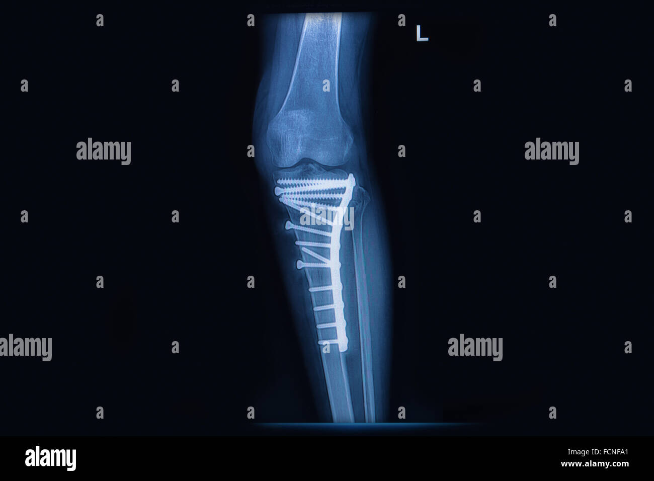 x-ray of fracture tibia(leg bone). tibia bone with internal fixed by ...