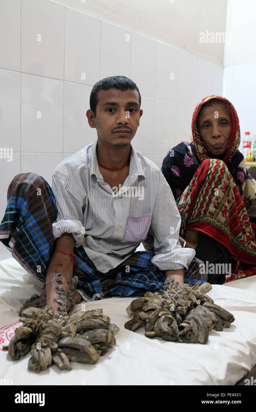 Dhaka, Bangladesh. 4th Feb, 2016. : Family with Tree Man, mother in ...