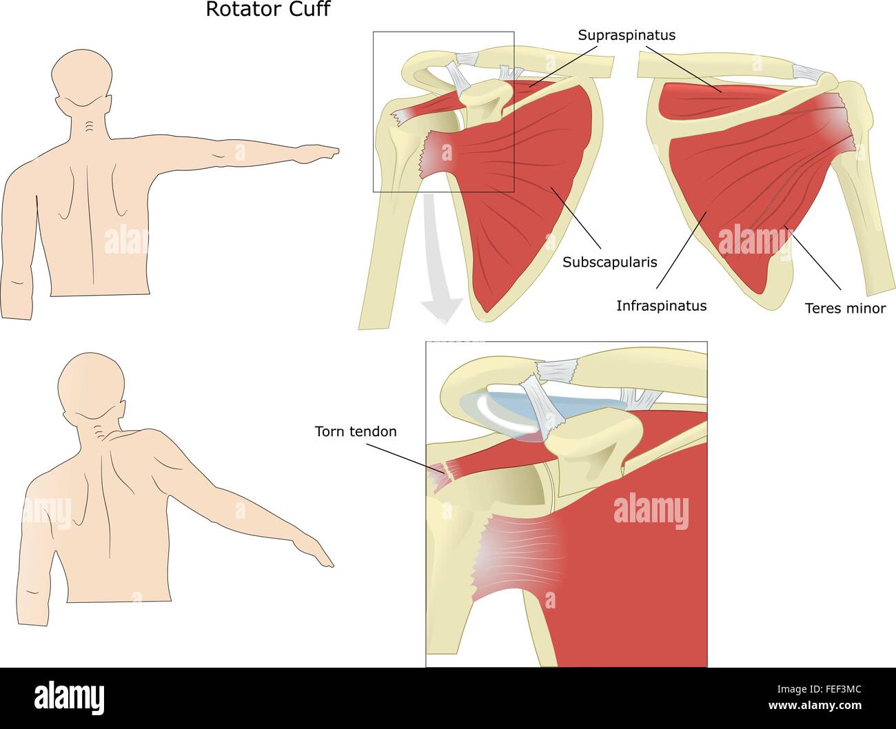 Shoulder Damaged High Resolution Stock Photography and Images - Alamy