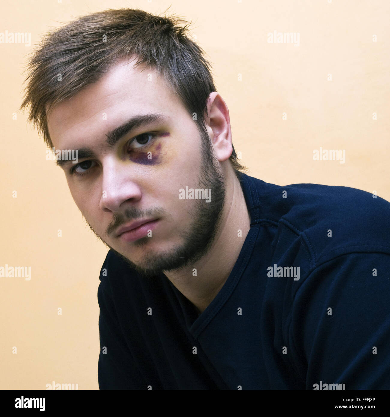 Handsome young man with a shiner. Portrait Stock Photo - Alamy