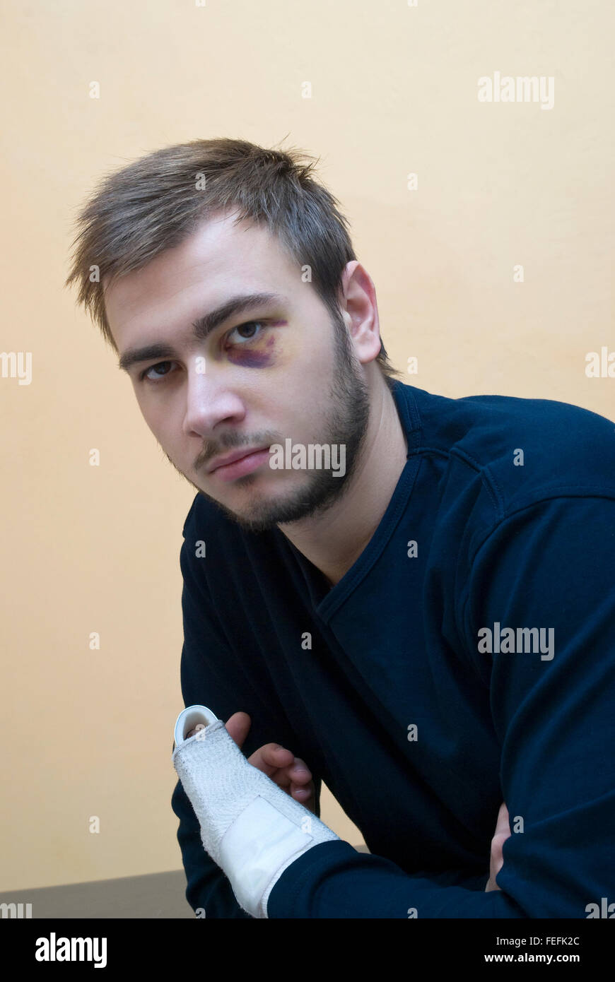 Handsome young man with a shiner. Portrait Stock Photo - Alamy
