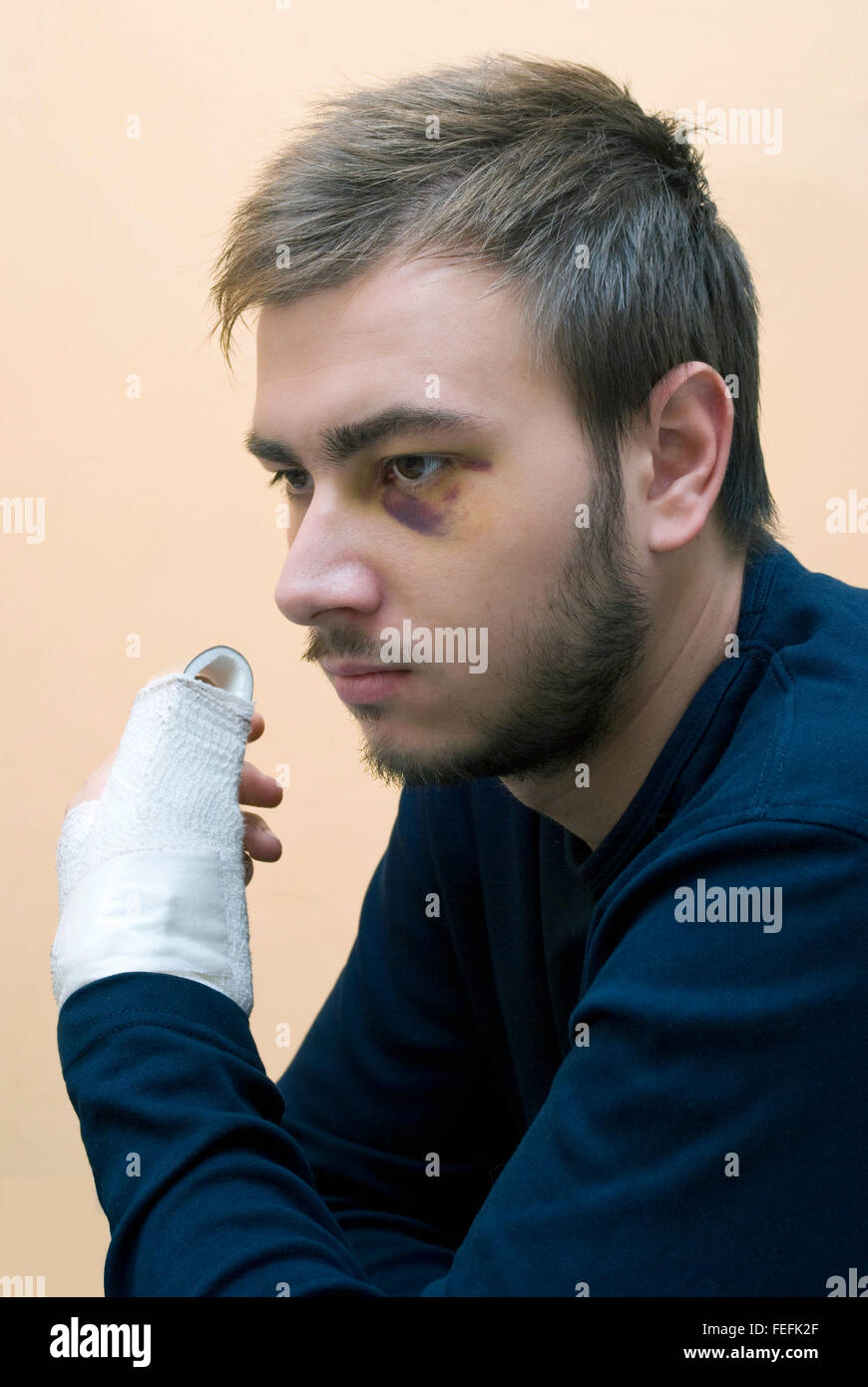 Handsome young man with a shiner. Portrait Stock Photo - Alamy