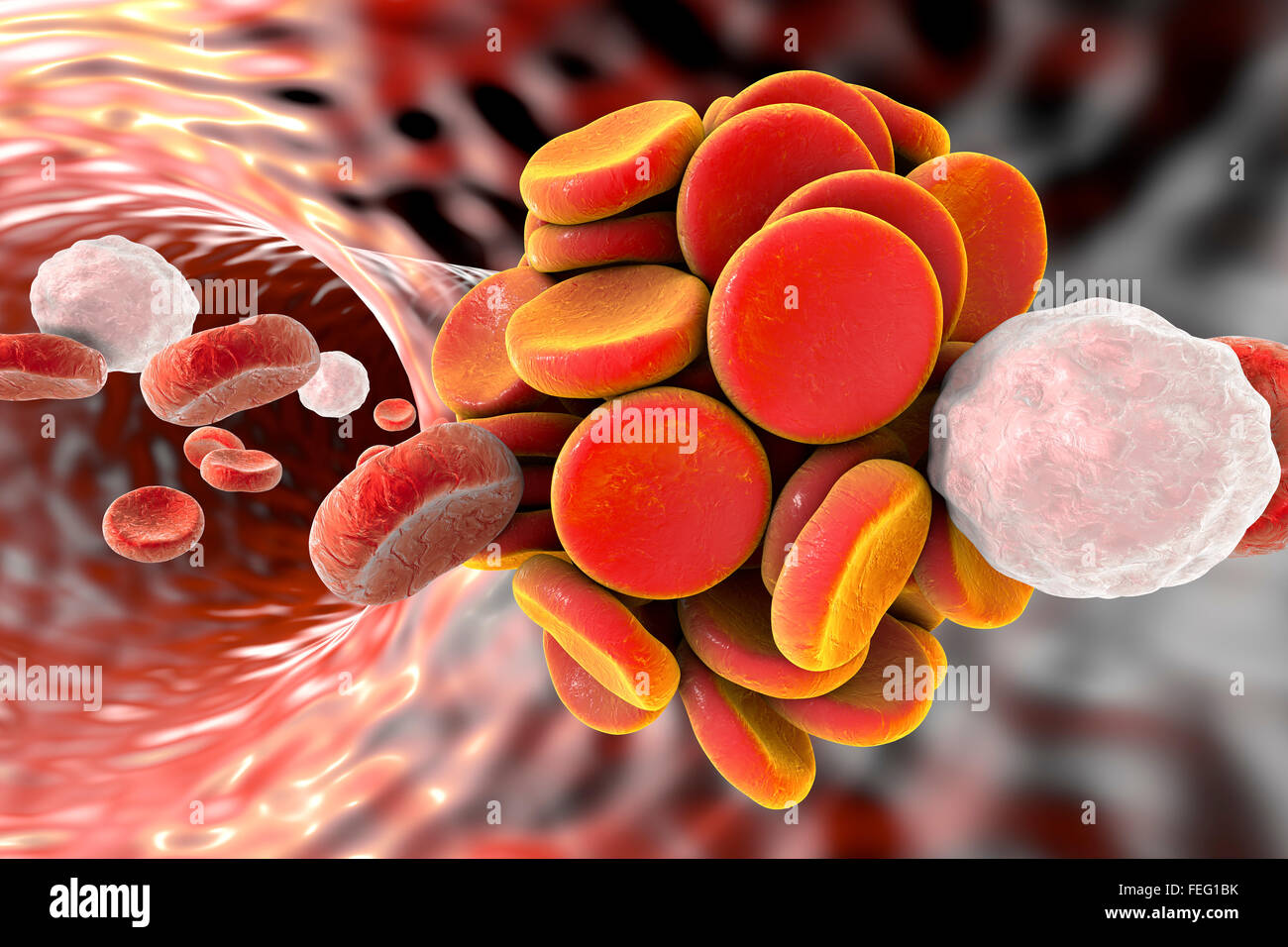 Blood clot, or thrombus, containing red blood cells and leukocyte ...