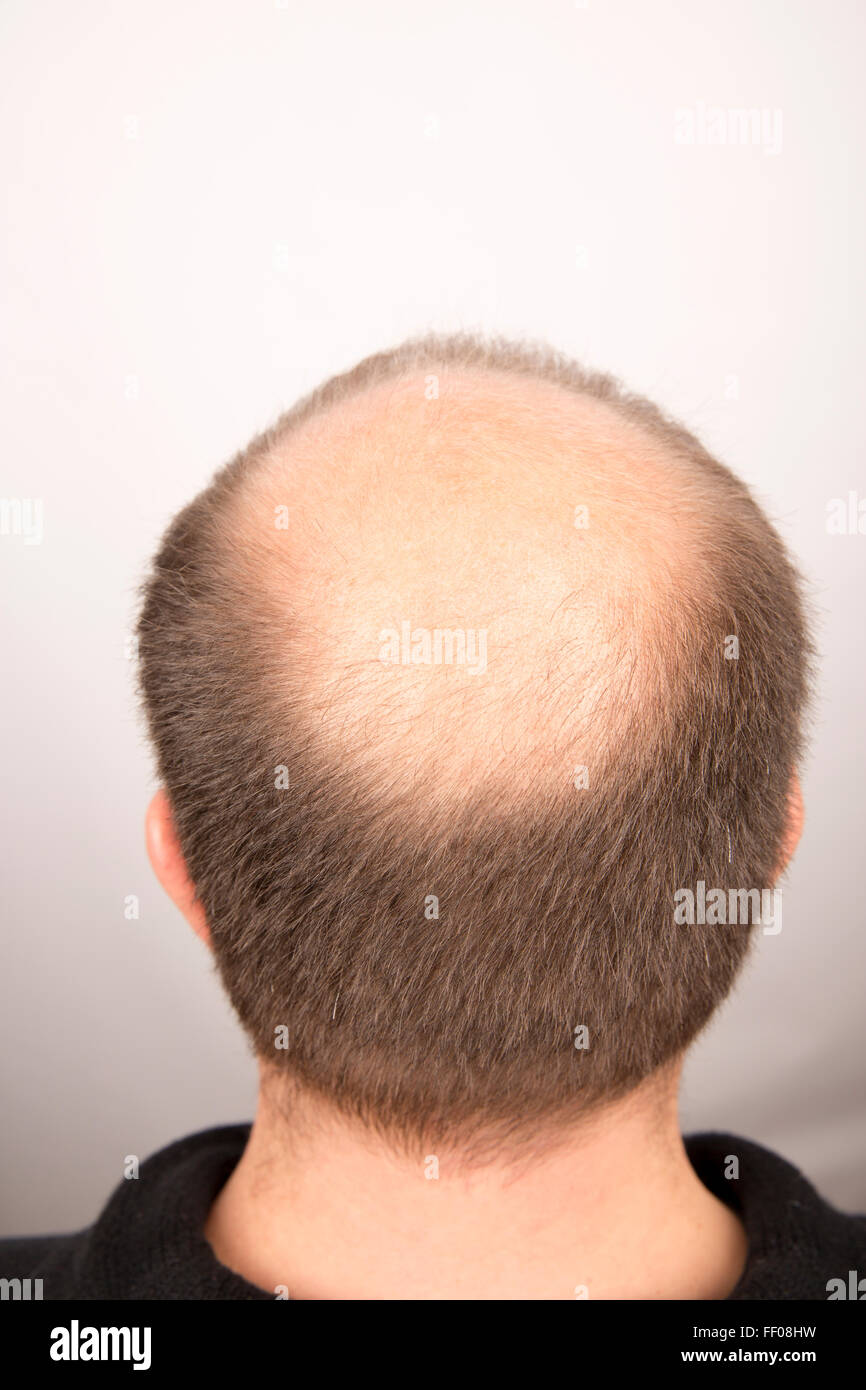 man controls hair loss stress alopecia cancer treatment Stock Photo - Alamy