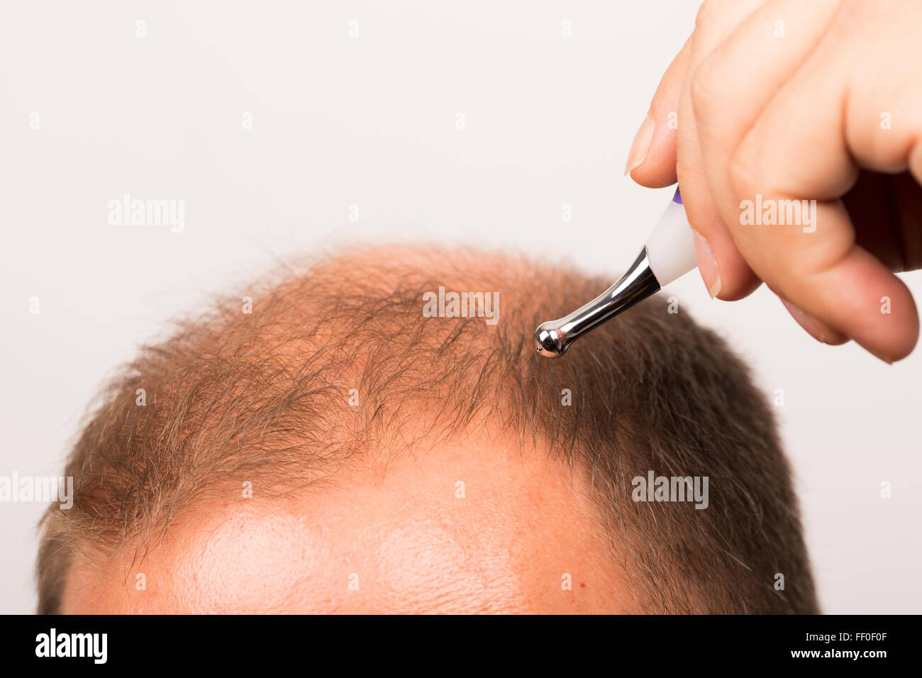 man controls hair loss stress alopecia cancer treatment Stock Photo - Alamy