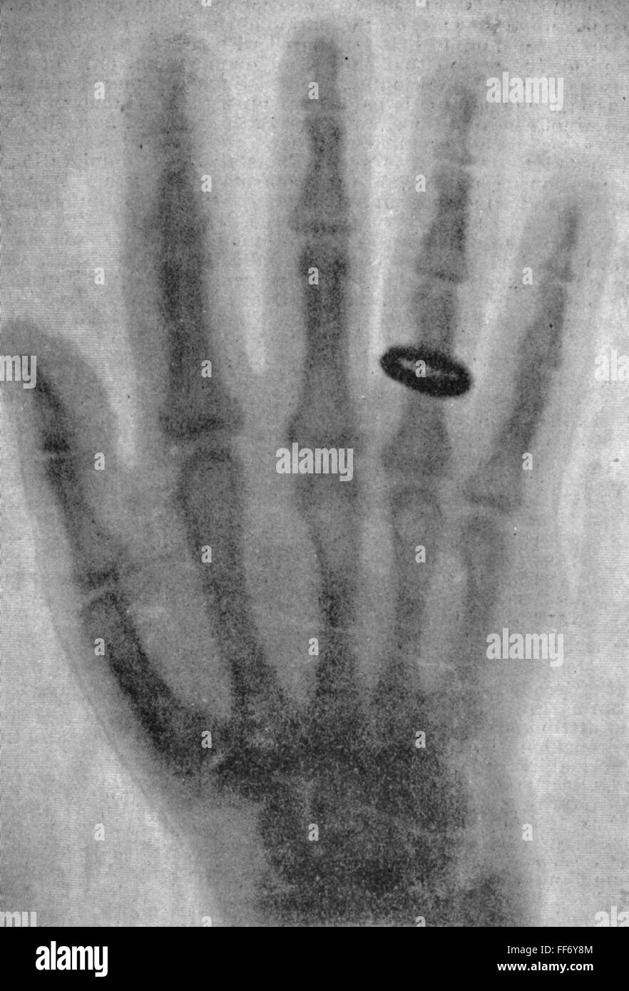 ROENTGEN X-RAY, 1896. /nThe first published X-ray photograph, as ...
