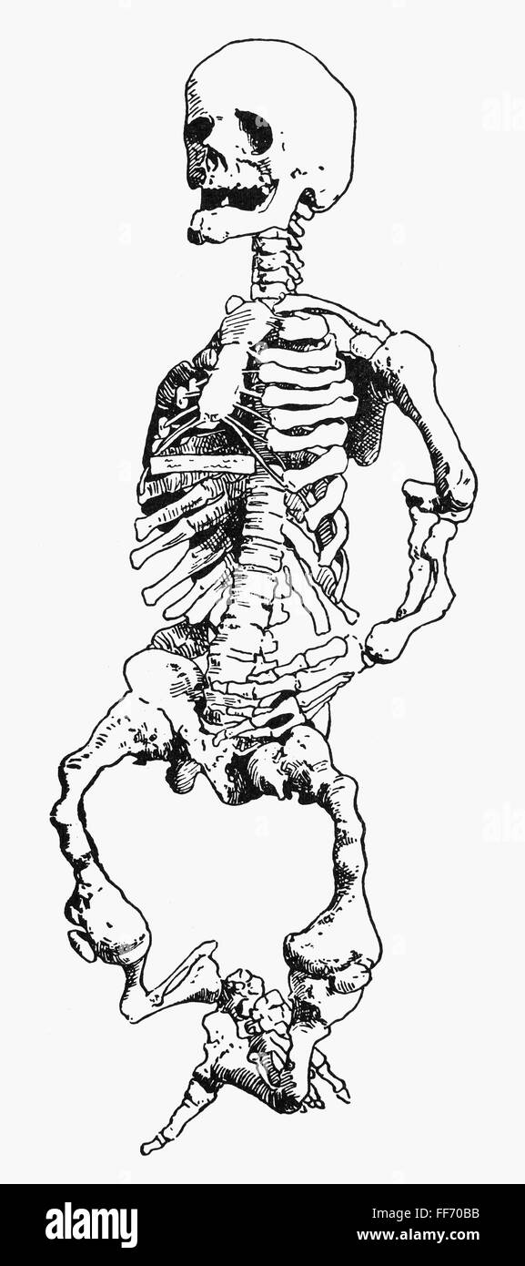 RICKETS. /nExtreme deformity of the skeleton of a 21 year-old Native ...