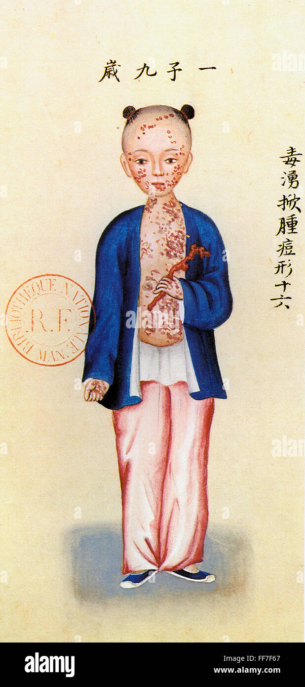 CHINA: SMALLPOX. /nChinese girl suffering from smallpox: watercolor ...