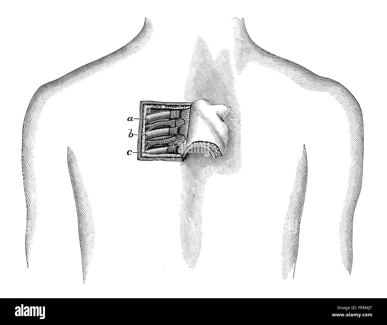 SURGERY, 19th CENTURY. /nOperation of a posterior thoracotomy, the ...