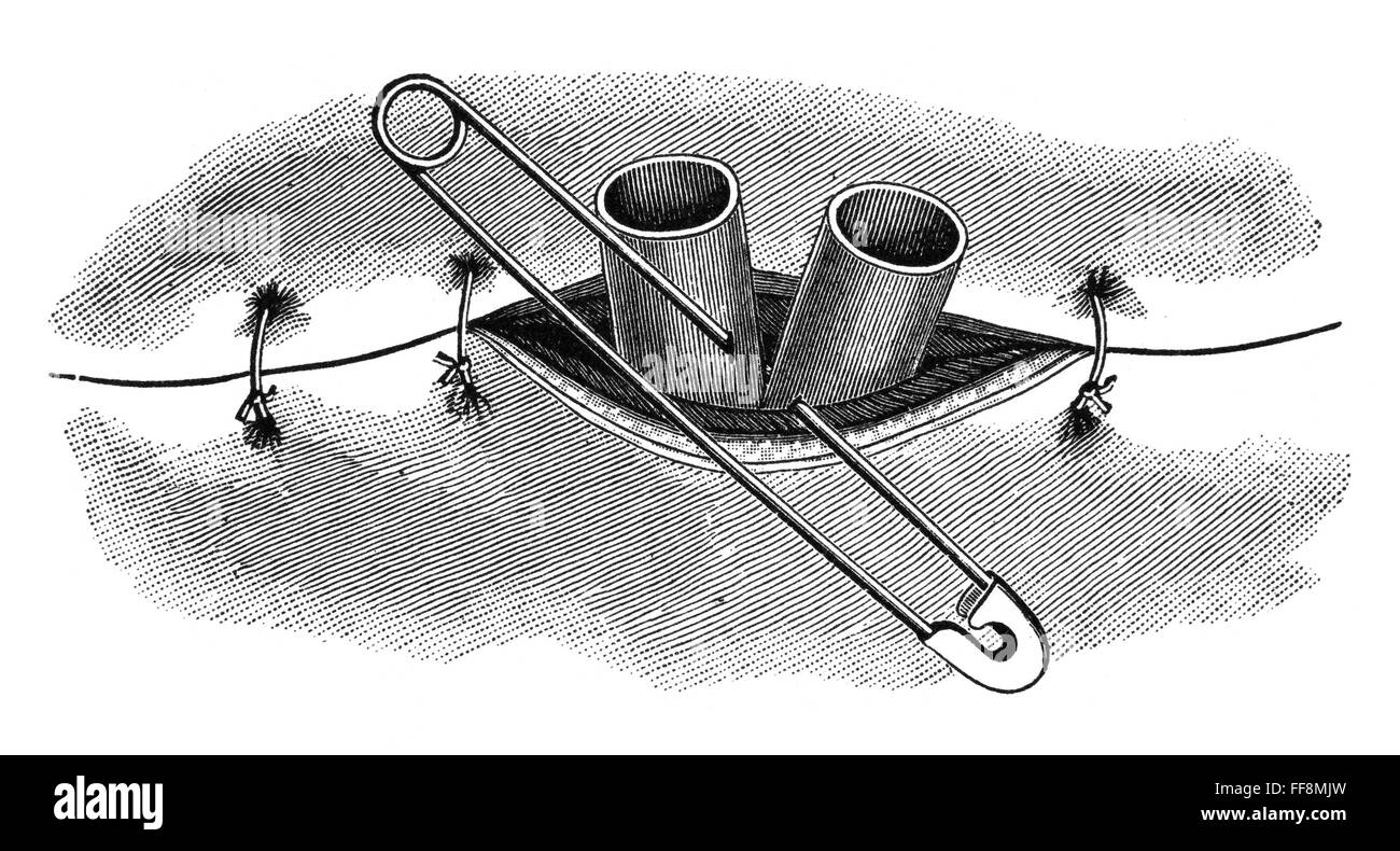 SURGERY, 19th CENTURY. /nDetail of a thoracoplasty, the operation of ...