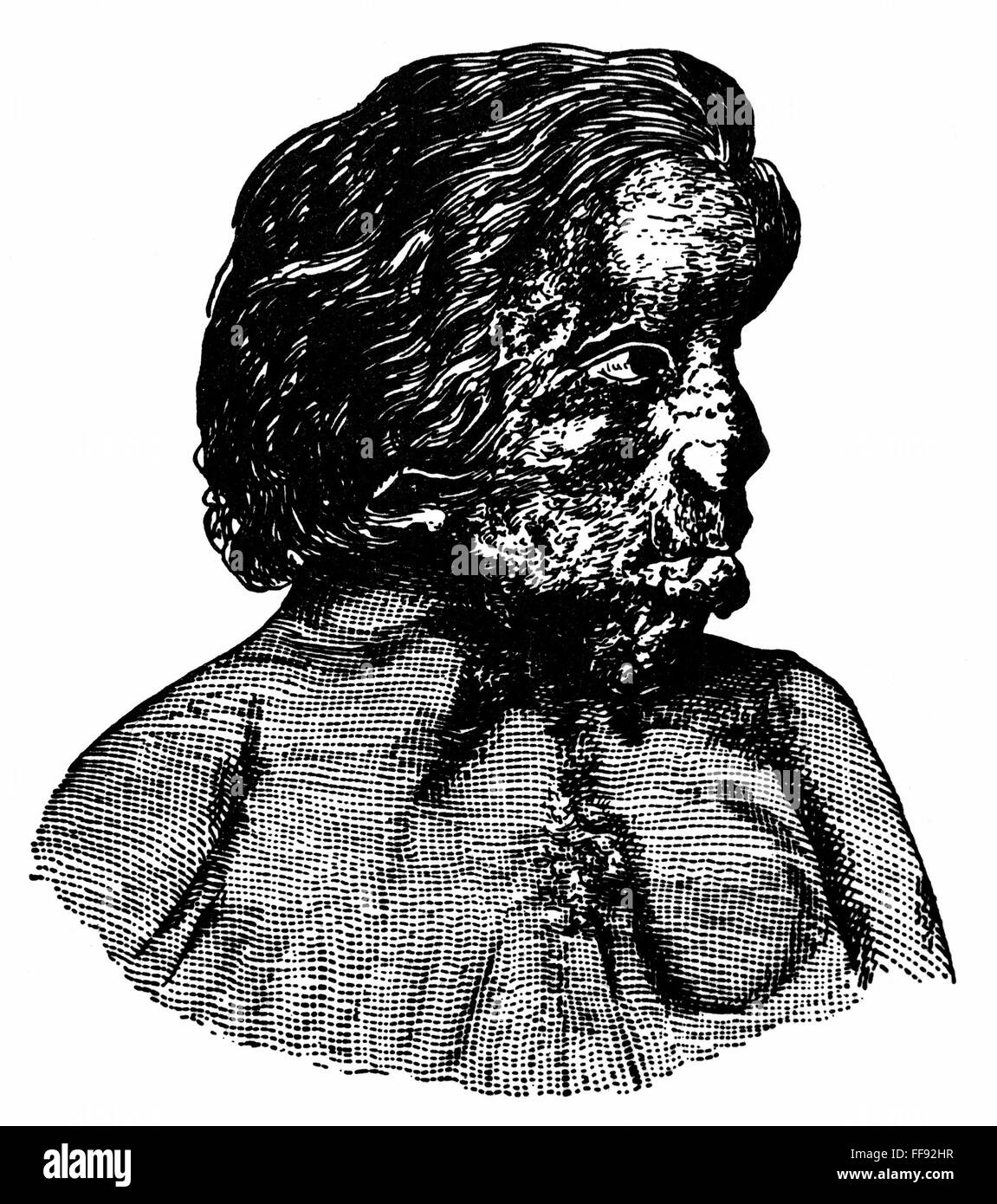 John merrick elephant man Cut Out Stock Images & Pictures - Alamy