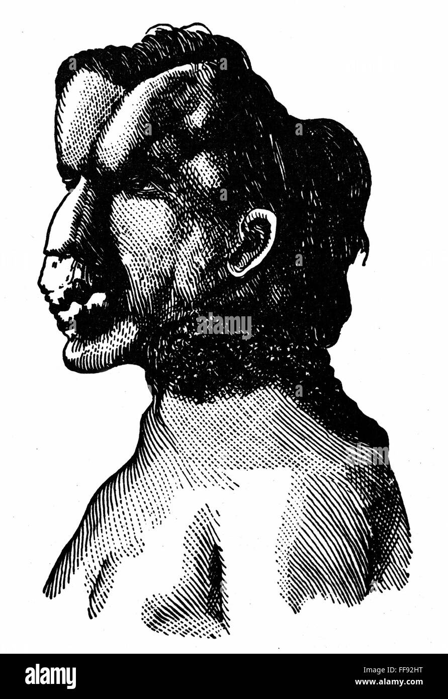 JOSEPH MERRICK (1864-1890). /nEnglish medical anomaly, known as the ...