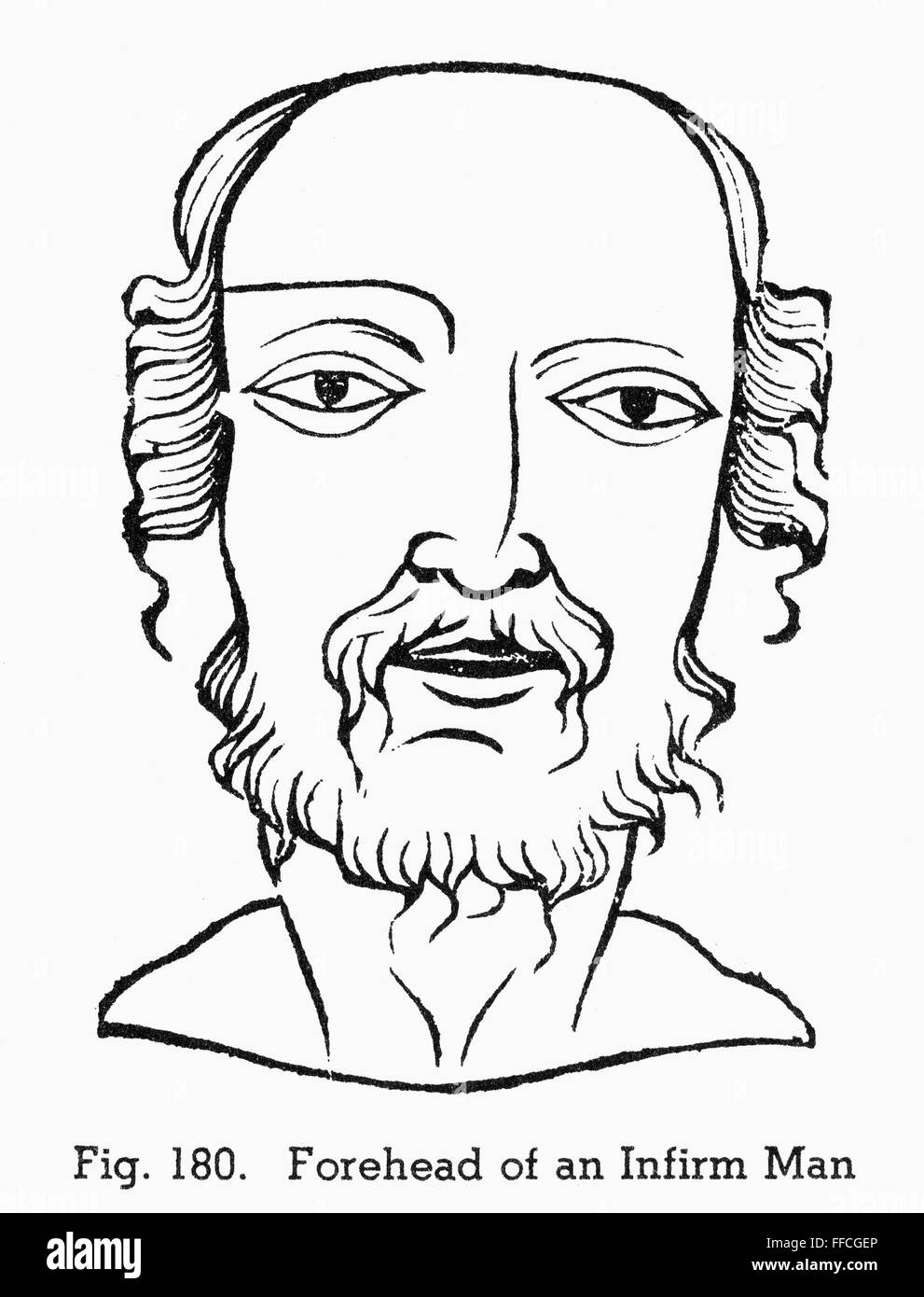 PHYSIOGNOMY, c1658. /nForehead of an infirm man. Woodcut, 1658, from ...