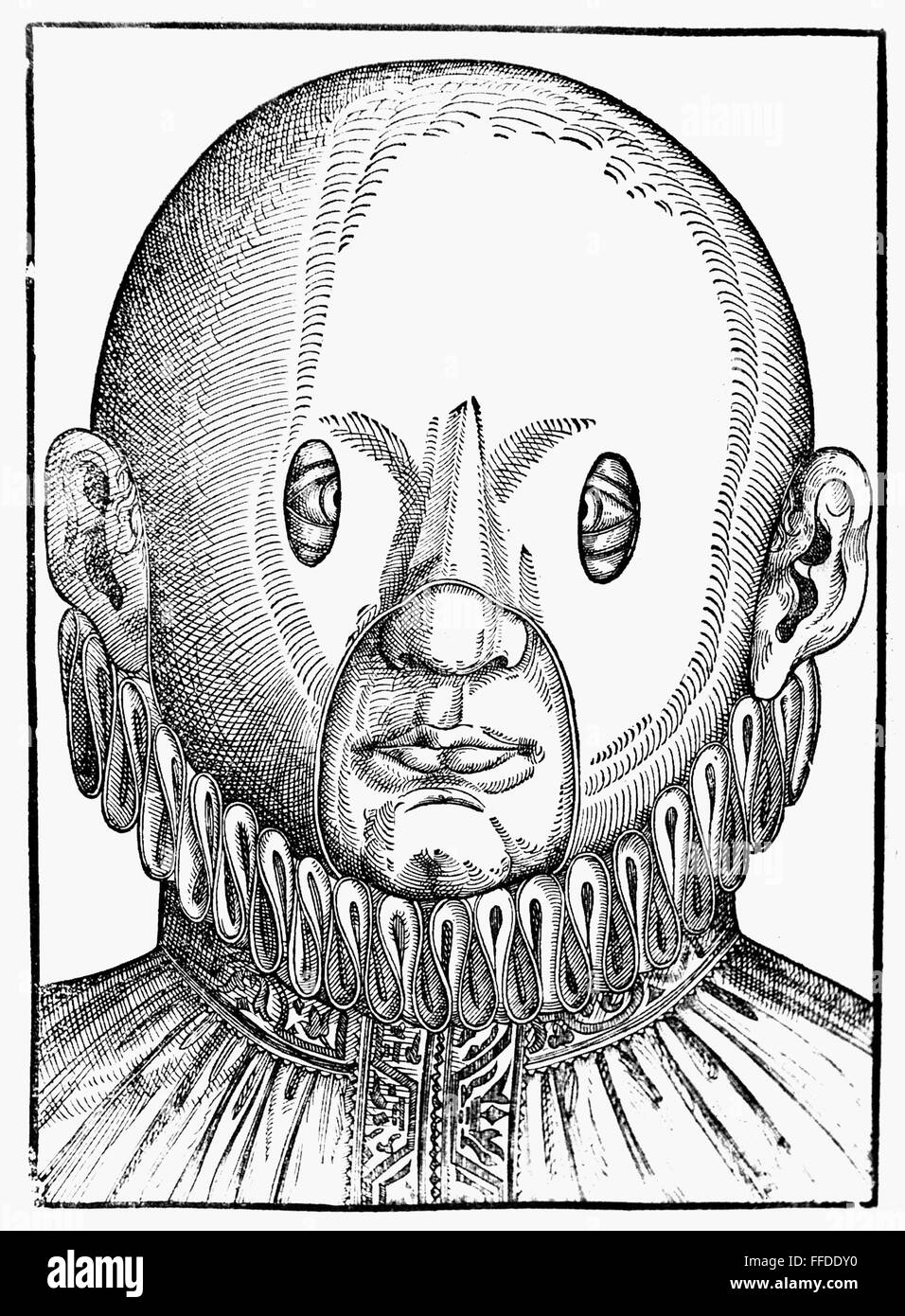EYE TREATMENT, 1583. /nA mask for treating strabismus (crossed eyes ...