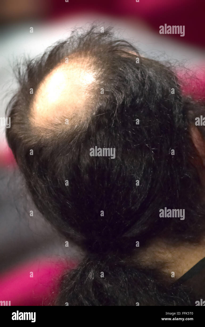 bald patch / receding hairline Stock Photo - Alamy