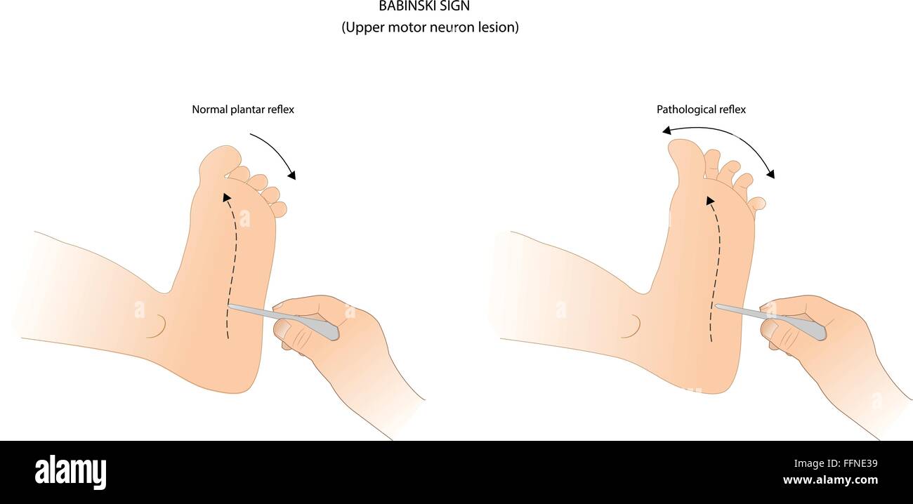 Babinski sign hi-res stock photography and images - Alamy